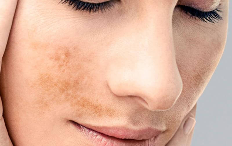 Los 8 problemas de la piel más comunes en las mujeres